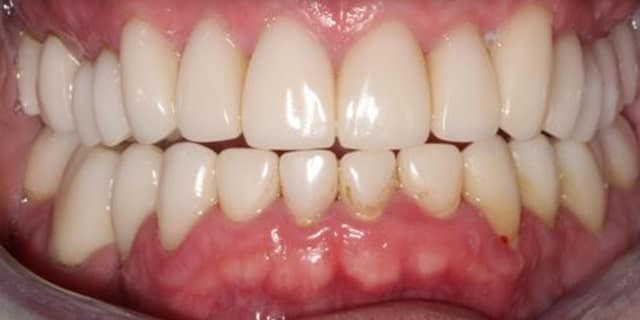 Broken, Worn Teeth Transformation Patient